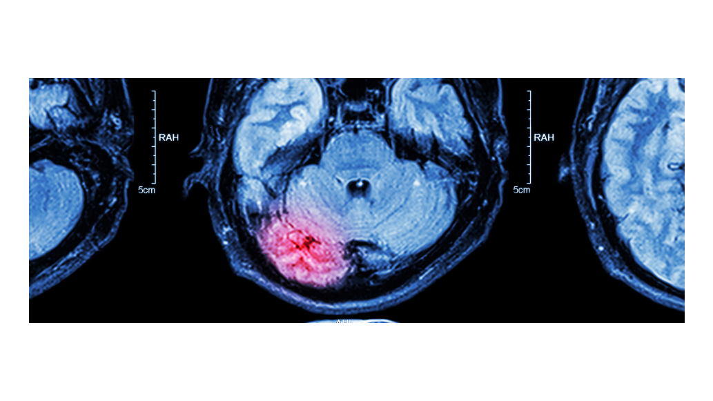 Red Light Therapy in Concussion Management | Medco Athletics | Medco ...